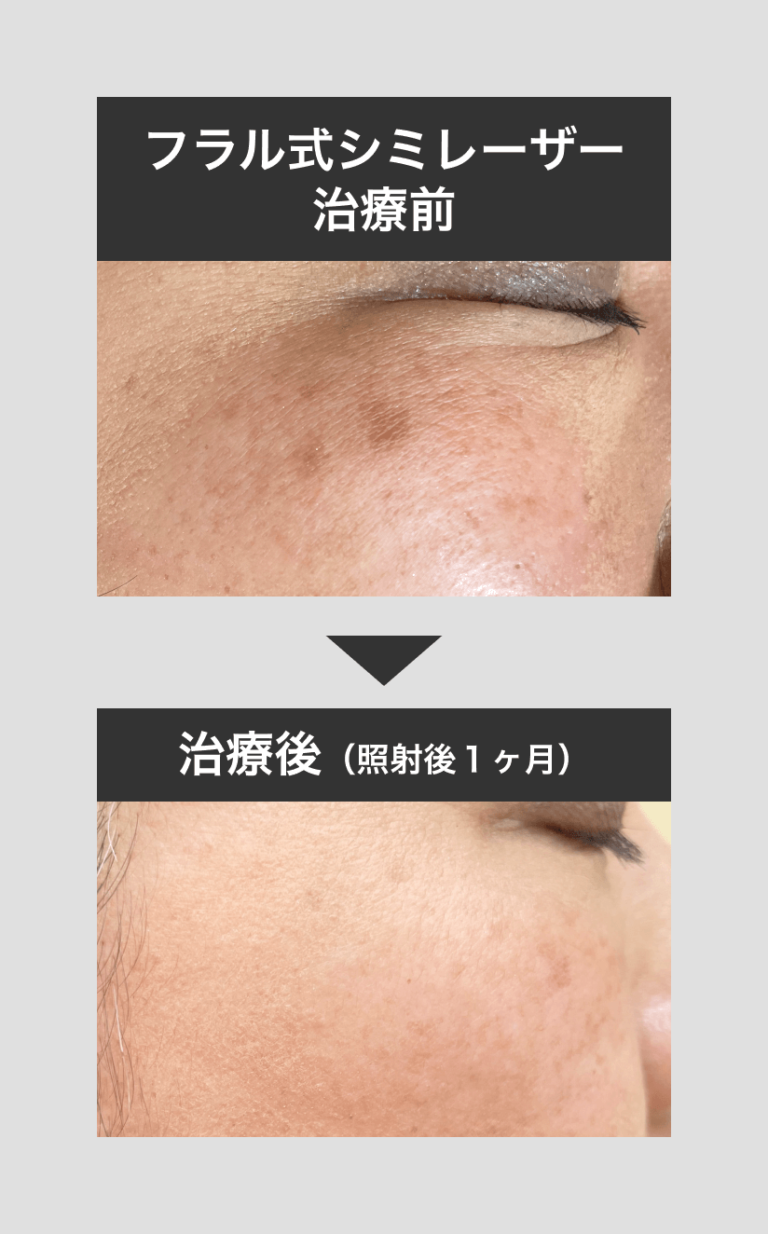 症例一覧 - 東京・大阪の美容皮膚科ならFLALU（フラルクリニック）