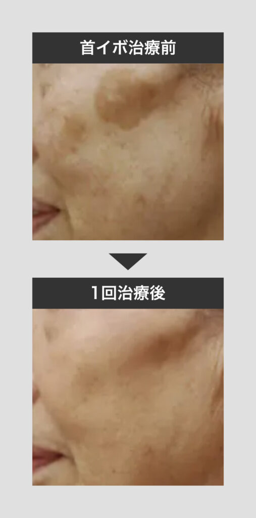 シミ取りレーザー5・10（5個・10個までシミが取り放題） - 東京・大阪の美容皮膚科ならFLALU（フラルクリニック）