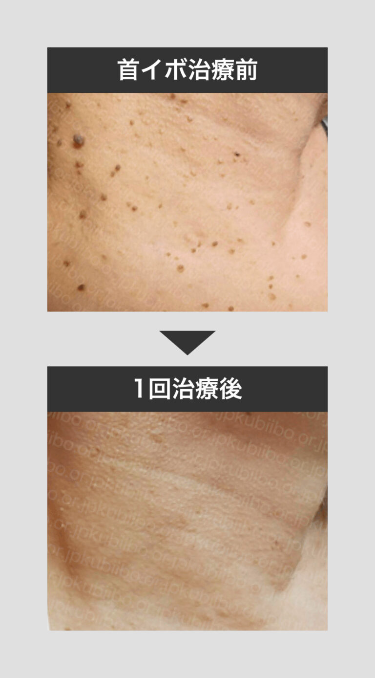 首イボに市販薬やクリームは効く？皮膚科医が解説する正しい治療法 - 東京・大阪の美容皮膚科ならFLALU（フラルクリニック）