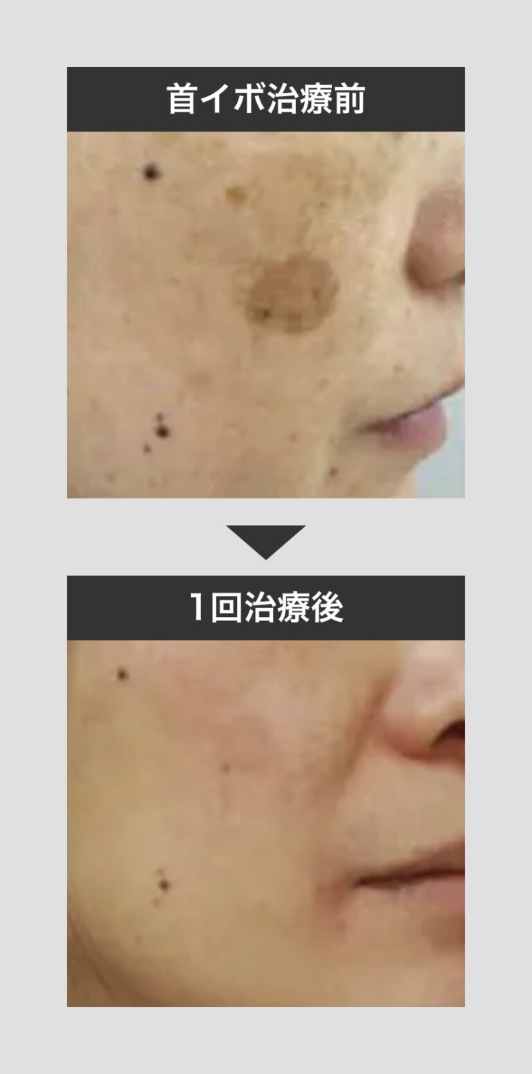 シミ取りレーザー5・10（5個・10個までシミが取り放題） - 東京・大阪の美容皮膚科ならFLALU（フラルクリニック）