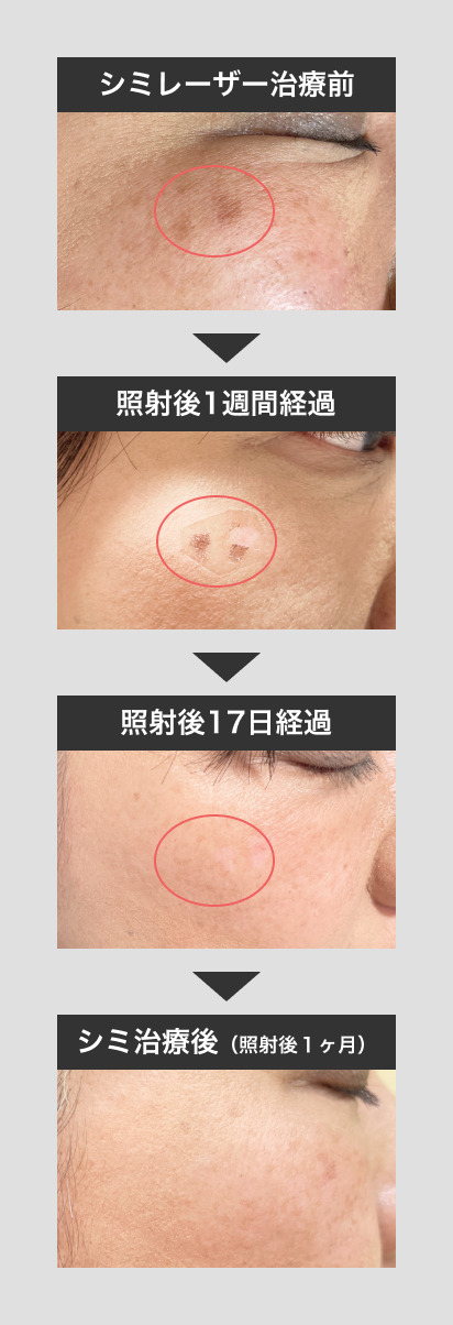 シミ取りレーザー5・10（5個・10個までシミが取り放題） - 東京・大阪の美容皮膚科ならFLALU（フラルクリニック）