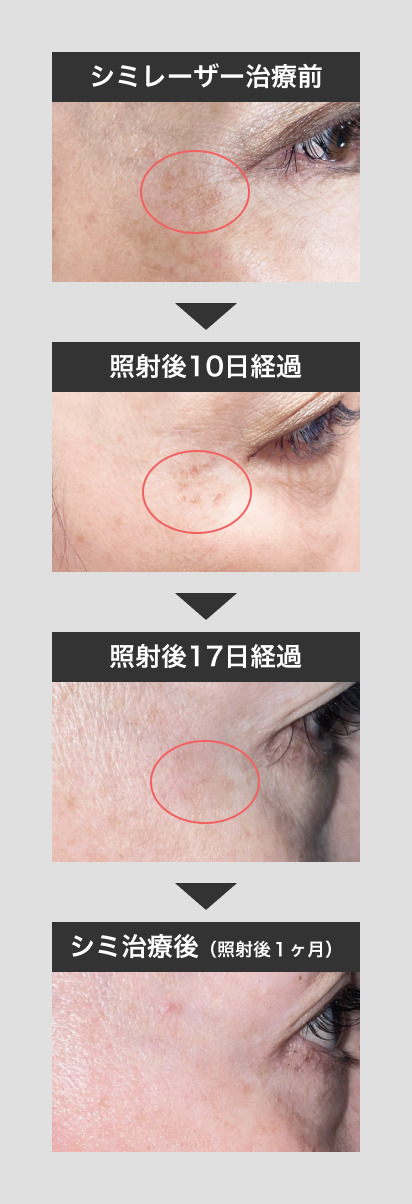シミ取りレーザー5・10（5個・10個までシミが取り放題） - 東京・大阪の美容皮膚科ならFLALU（フラルクリニック）