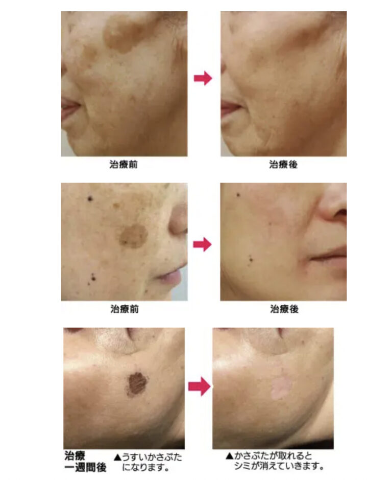 シミ取りレーザー5・10（5個・10個までシミが取り放題） - 東京・大阪の美容皮膚科ならFLALU（フラルクリニック）