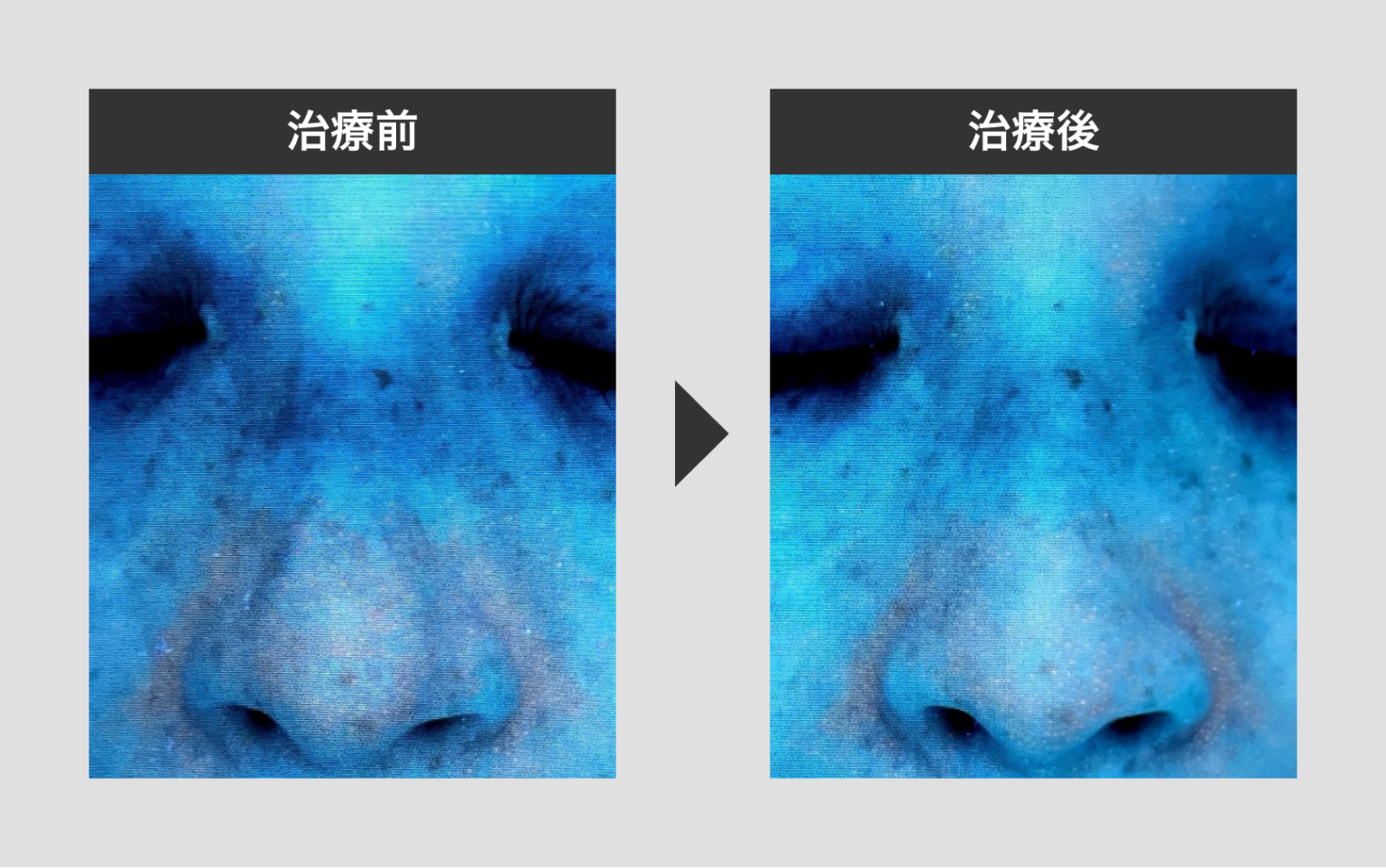 「レアセラム （RARE SERUM 35）」高浸透型ビタミンC誘導体美容液 - 東京・大阪の美容皮膚科ならFLALU（フラルクリニック）