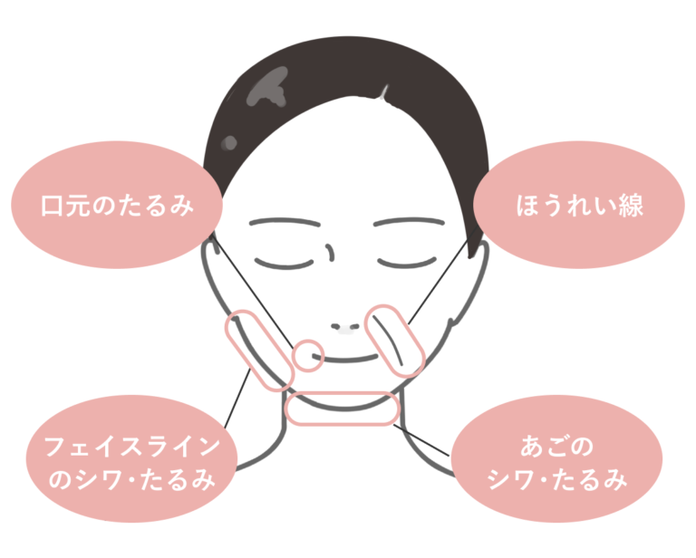 美容施術「テノールNEO」のたるみ改善効果（東京院） - 東京・大阪の美容皮膚科ならFLALU（フラルクリニック）