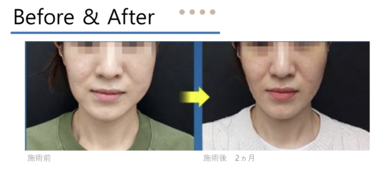 美容施術「テノールNEO」のたるみ改善効果（東京院） - 東京・大阪の美容皮膚科ならFLALU（フラルクリニック）