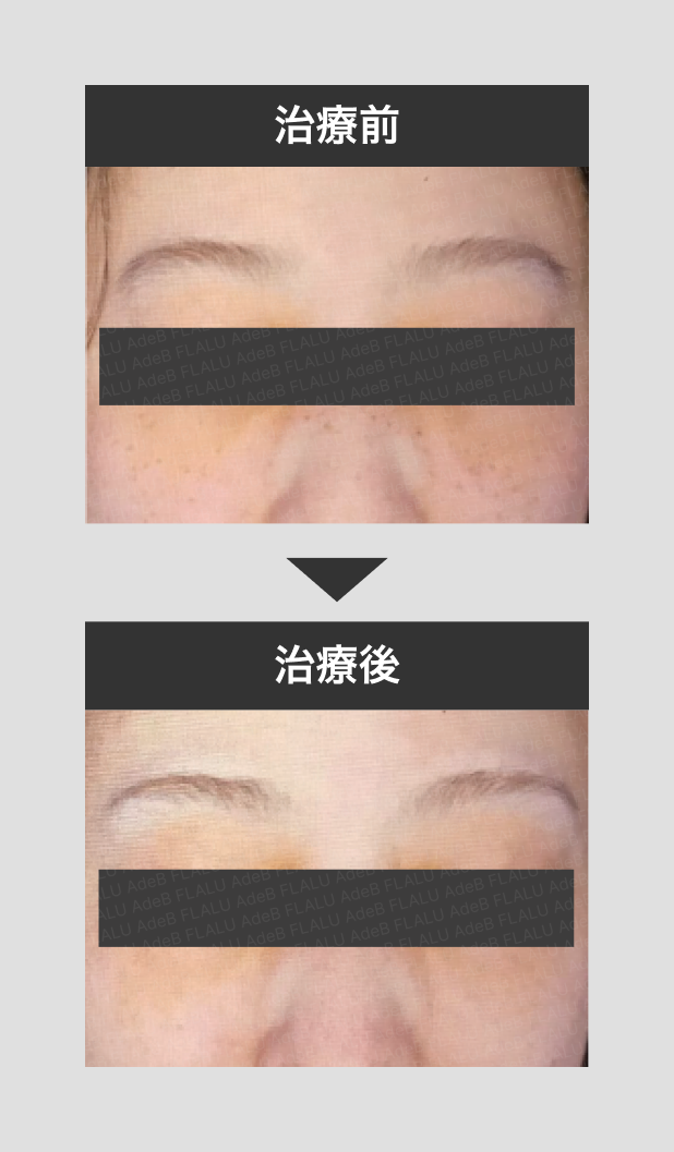 フォトフェイシャルM22（大阪梅田院） - 東京・大阪の美容皮膚科ならFLALU（フラルクリニック）