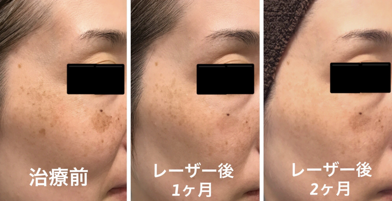 シミ取りレーザーの失敗例 - 東京・大阪の美容皮膚科ならFLALU（フラルクリニック）