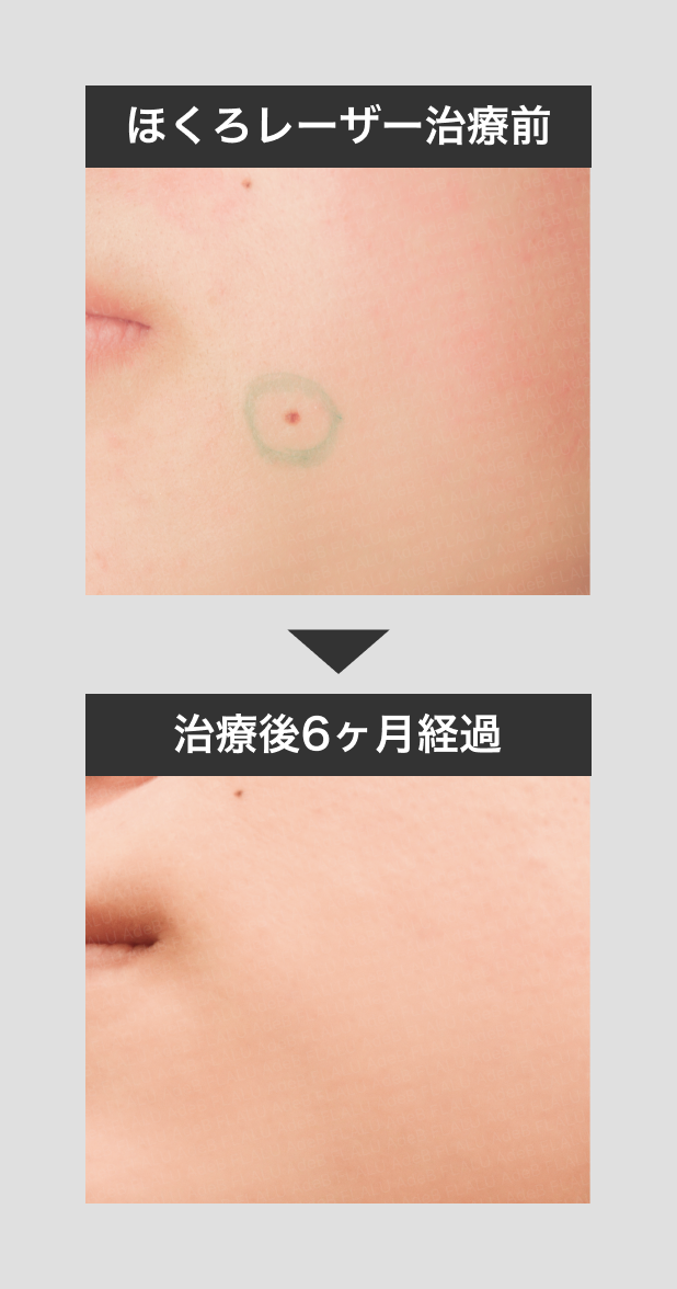 ほくろ除去レーザー（大阪梅田院） - 東京・大阪の美容皮膚科ならFLALU（フラルクリニック）
