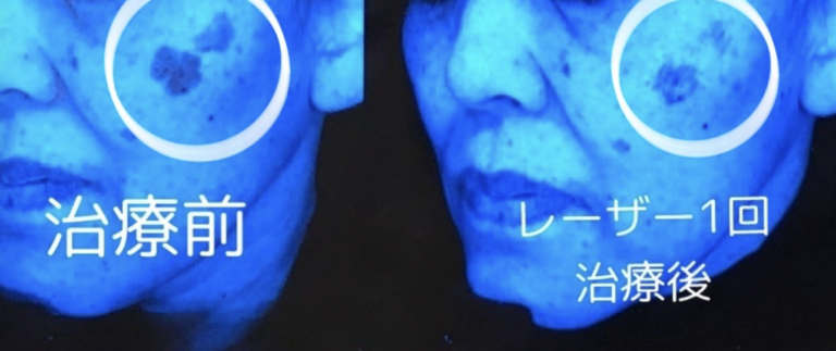 シミ取りレーザーの失敗例 - 東京・大阪の美容皮膚科ならFLALU（フラルクリニック）