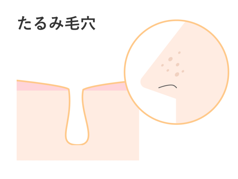 たるみ毛穴を引き締める！効果的な改善法を解説 - 東京・大阪の美容皮膚科ならFLALU（フラルクリニック）