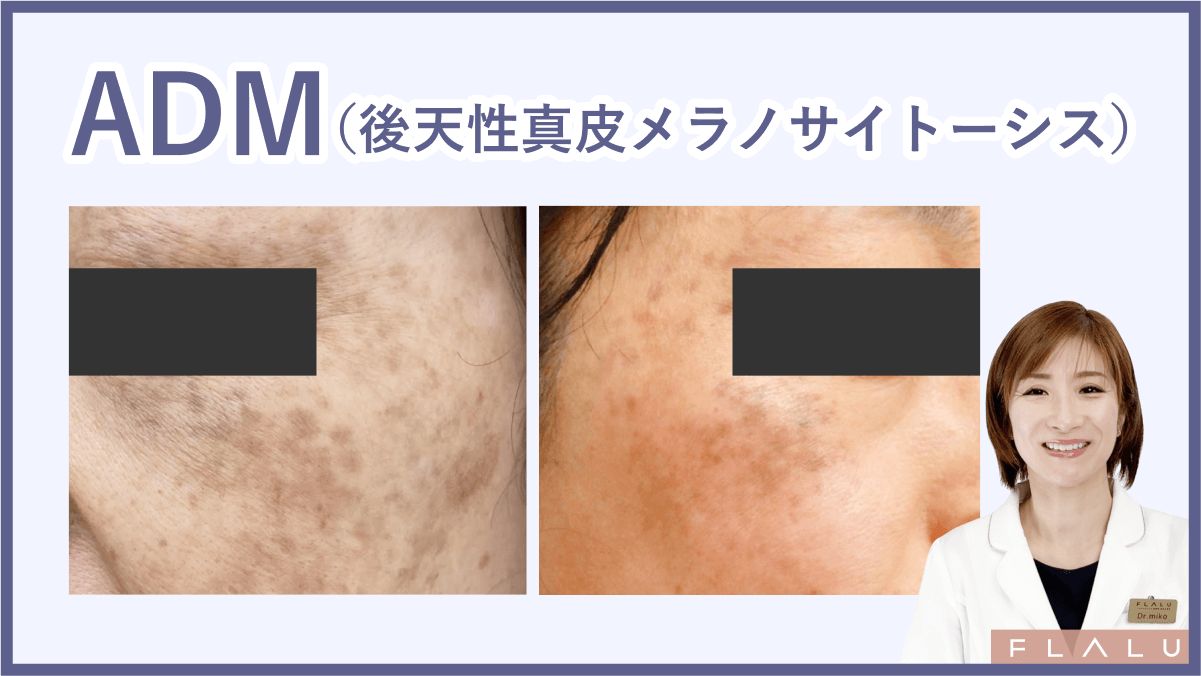 ADM（後天性真皮メラノサイトーシス） - 東京・大阪の美容皮膚科ならFLALU（フラルクリニック）