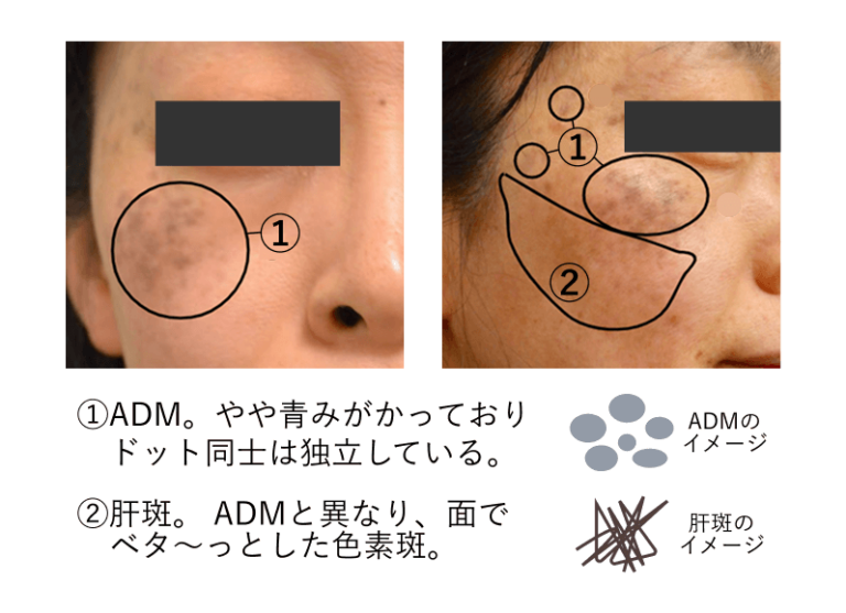 ADM（後天性真皮メラノサイトーシス） - 東京・大阪の美容皮膚科ならFLALU（フラルクリニック）