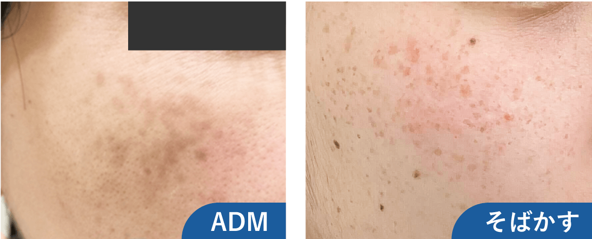 ADM（後天性真皮メラノサイトーシス） - 東京・大阪の美容皮膚科ならFLALU（フラルクリニック）
