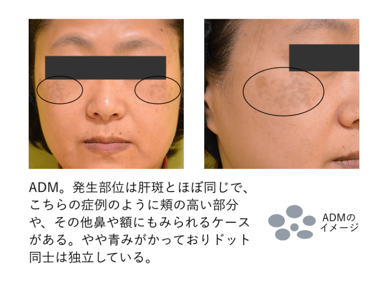 ADM（後天性真皮メラノサイトーシス） - 東京・大阪の美容皮膚科ならFLALU（フラルクリニック）