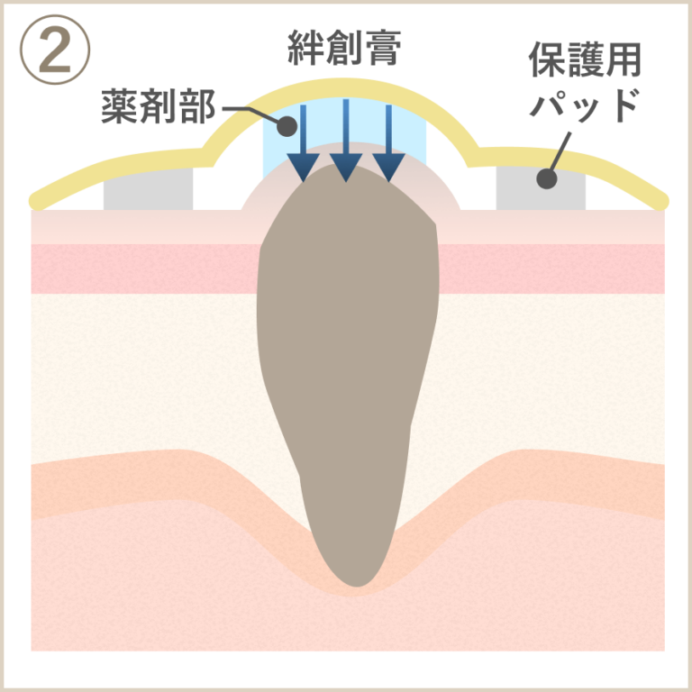 イボコロリの効果は？どんなイボに効く？皮膚科医が正しい使い方を解説 - 東京・大阪の美容皮膚科ならFLALU（フラルクリニック）