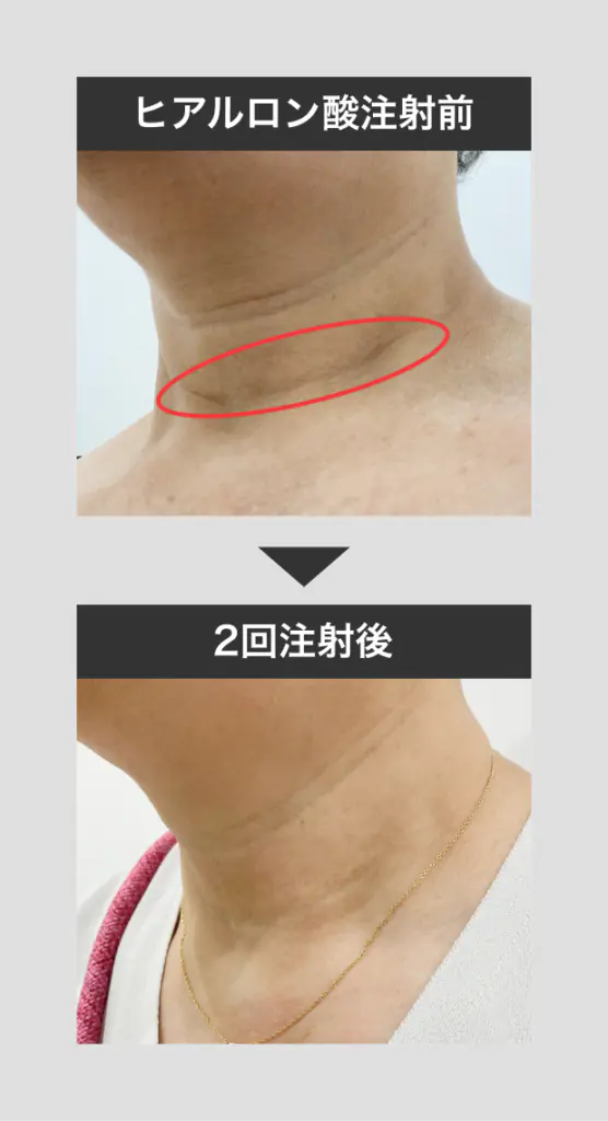 【募集を終了】首のシワ治療の半額モニターを大募集（先着順）FLALUクリニック大阪院 - 東京・大阪の美容皮膚科ならFLALU（フラルクリニック）